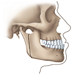 Ferraris Dental Care > Conditions and Treatments > Corrective Jaw Surgery
